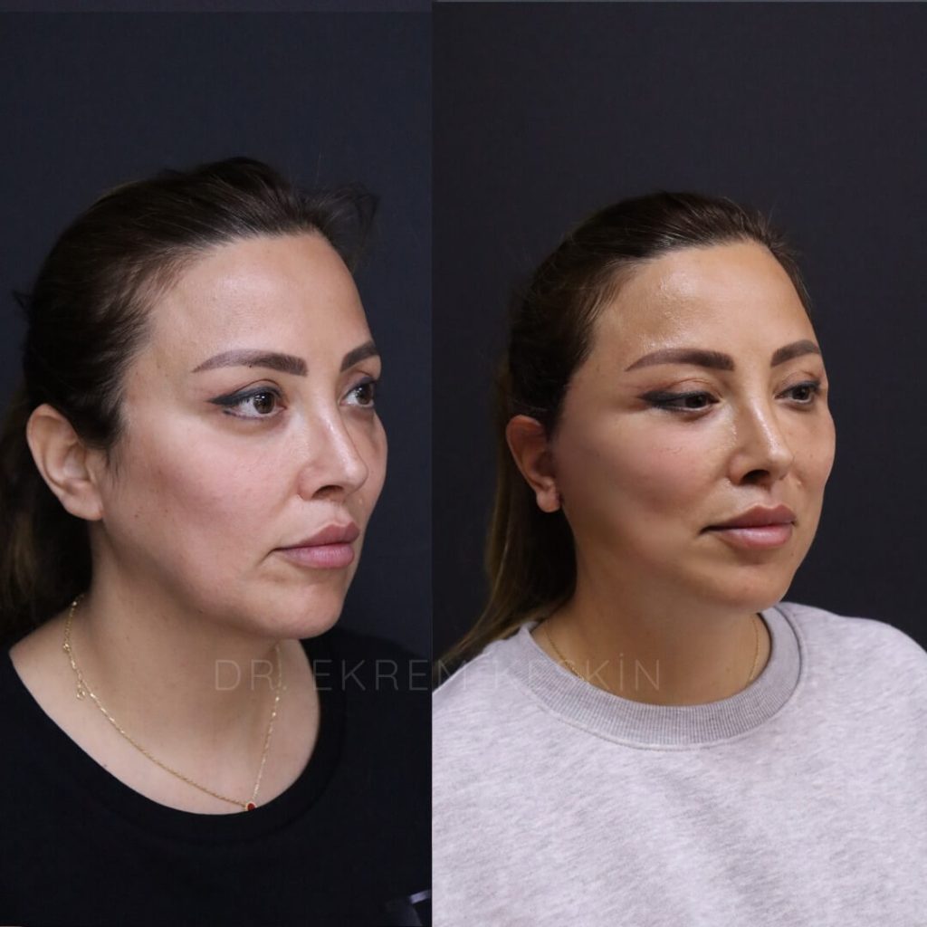 Yüz Germe Fiyatları 2025 | Op. Dr. Ekrem Keskin