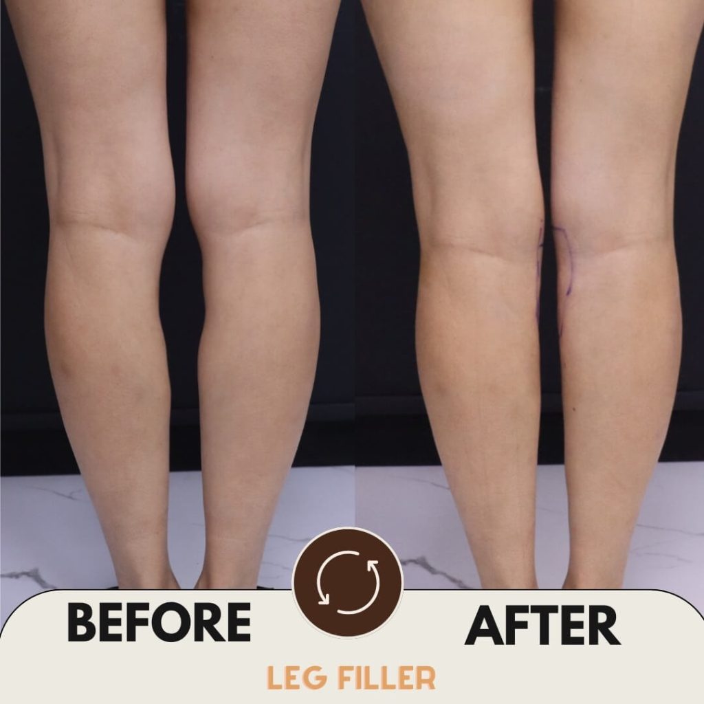 Bacak Dolgusu Fiyatları 2024 | Op. Dr. Ekrem Keskin